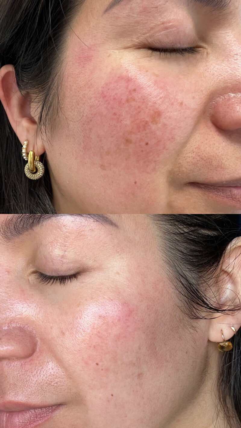 Wat is rosacea en wat kan ik ertegen doen? ⋆ Beautylab.nl